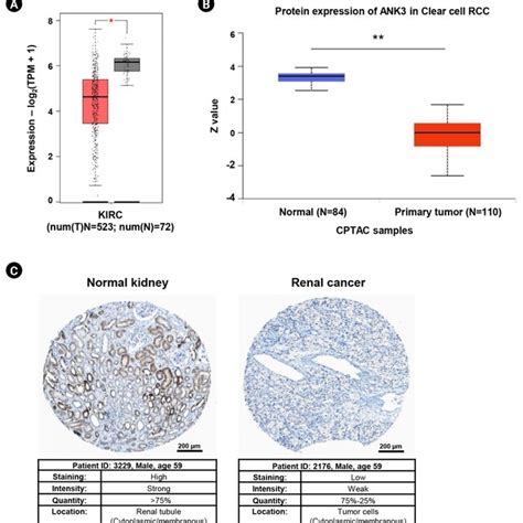 expression of ank3 mrna and protein in kirc tissues a boxplot of