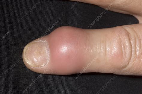 Gout In Finger Stock Image M Science Photo Library