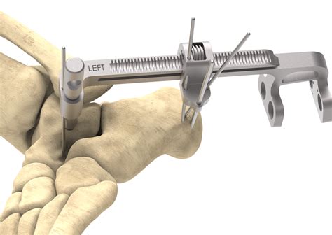 InCore Subtalar Zimmer Biomet