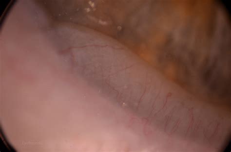 Atlas Entry Conjunctival Prolapse Under Scleral Contact Lens