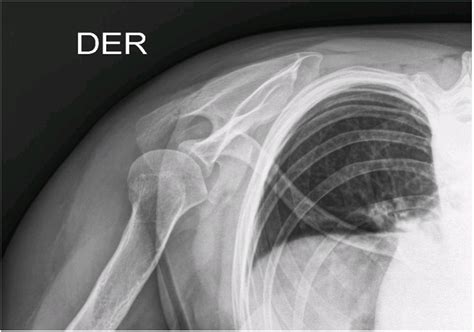 Axial Shoulder Anatomy 815x485