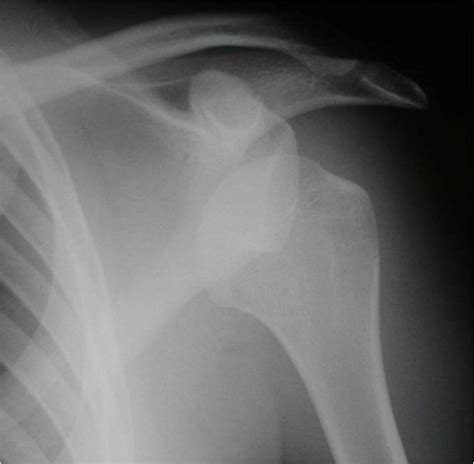 Conditions Glasgow Shoulder Clinic