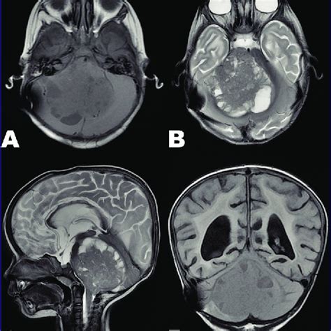 PDF Choroid Plexus Carcinoma A Case Report