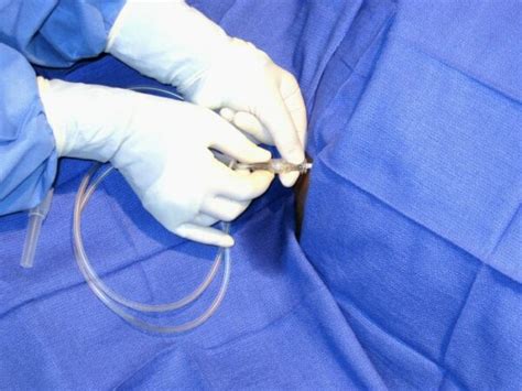 Paracentesis Procedure Steps In Emergency Situations Hospital Procedures Consultants