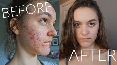How To Get Rid Of Acne Post Doxycycline My Skincare Routine Youtube