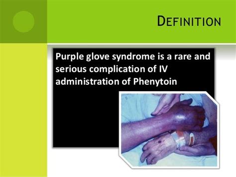 Purple Glove Syndrome