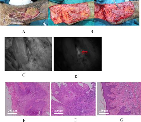 Figure 3 From Indocyanine Green Fluorescence Imaging In The Surgical Management Of Skin Squamous