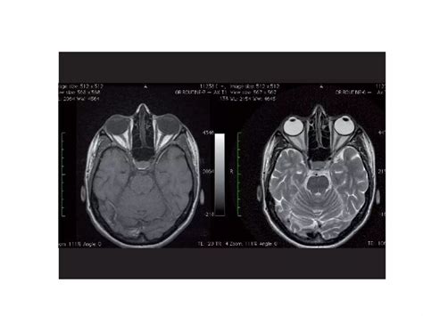 Orbital Calcification Pptx