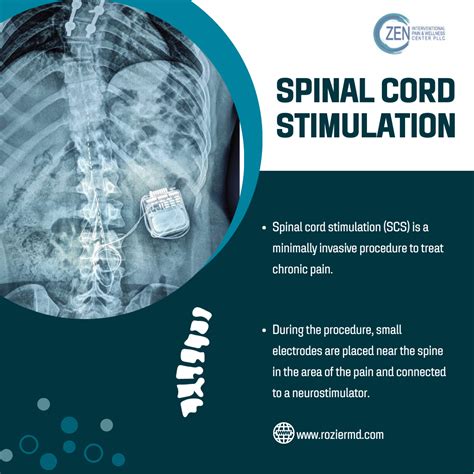 Benefits Of Spinal Cord Stimulation Patients Guide In Mansfield Tx