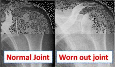 Shoulder Arthritis Brisbane Knee And Shoulder Clinic Dr Macgroartybrisbane Knee And Shoulder