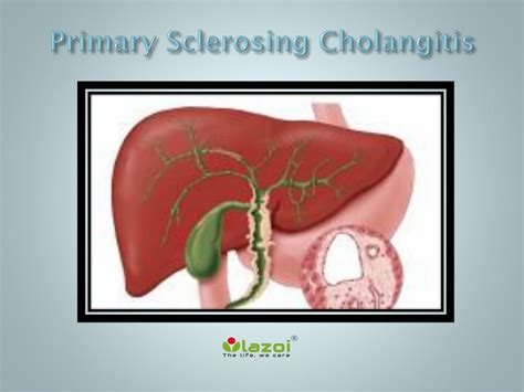 Ppt Primary Sclerosing Cholangitis Causes Symptoms Daignosis