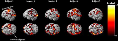 activation maps obtained from a 5‐min finger tapping task the