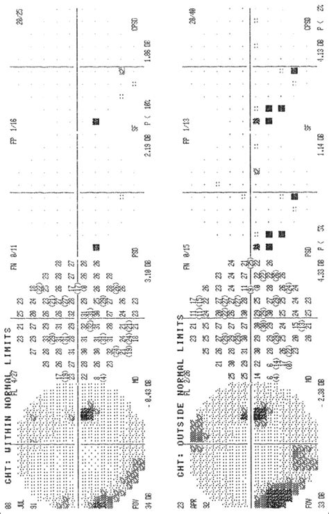 Visual Field Interpretation Ento Key