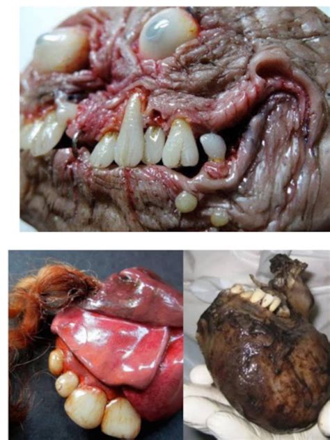 ¿qué Es Un Teratoma El Raro Tumor Al Que Le Puede Salir Dientes Cabello Y Hasta Huesos Infobae