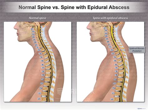 Normal Spine Vs Spine With Epidural Abscess Trialexhibits Inc