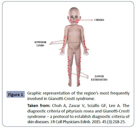 Histologia De Gianotti Crosti Gianotti Crosti Syndrome Of Atypical