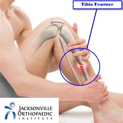 Broken Tibia Out Of Skin