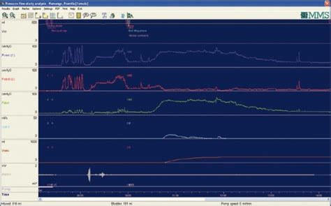 Urodynamic Tracing Of Bladder Outlet Obstruction In A Female Download