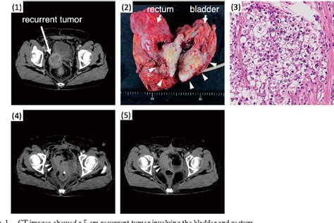 Figure 1 From Successful Management Of Pelvic Recurrence Of Msi High