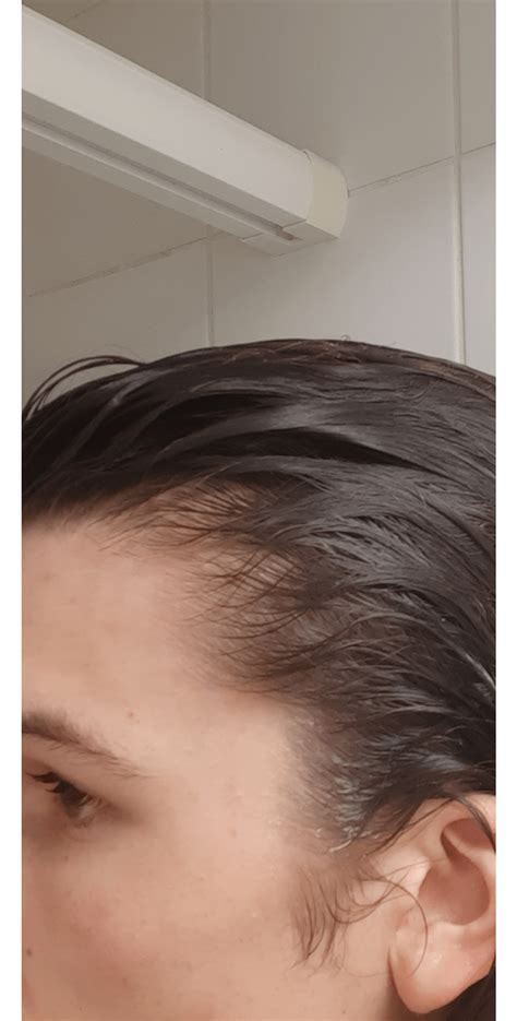 Balding Or Not First 2 Pics Are Wet Hair M18 R Malehairadvice