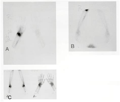 Bone Scan Injection Artifacts Clinical Nuclear Medicine