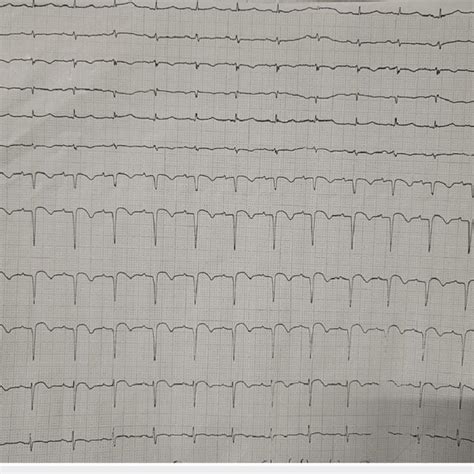 Electrocardiogram Showing St Segment Elevation From V1 To V5 And T Wave