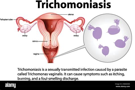 Trichomoniasis Infographic With Explanation Illustration Stock Vector Image And Art Alamy