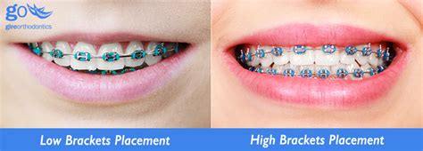 Selalu Tercabut Bracket Ketika Memakai Braces Kenapa Dan Apakah Tips