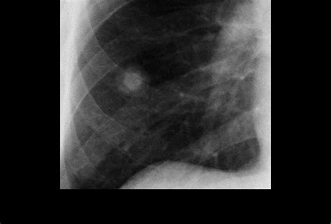 The Solitary Pulmonary Nodule Morphologic Clues For Benign Versus Malignant Lesions