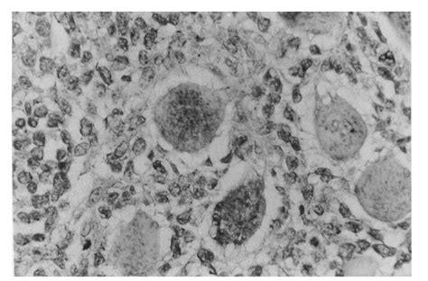 Primitive Neuroectodermal Tumor Pretreatment Immunostaining For Jsb 1