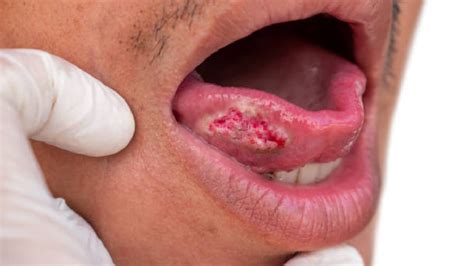 Oral Cancer ಬಾಯಿಯ ಕ್ಯಾನ್ಸರ್‌ನ ಈ 8 ಆರಂಭಿಕ ಲಕ್ಷಣಗಳನ್ನು ನಿರ್ಲಕ್ಷ್ಯಿಸಬೇಡಿ