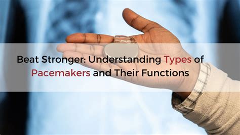 Pacemakers And Their Functions Modern Heart And Vascular