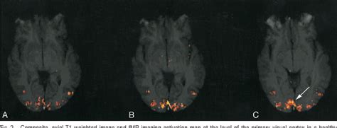 Figure 1 From Multiple Sclerosis Contrast In Healthy Volunteers And Patients With Luminance