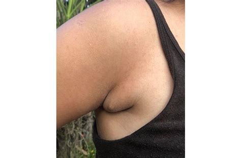 Polymastia Armpit