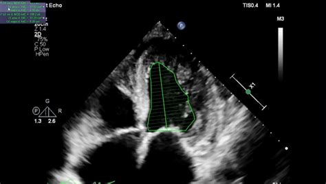 Echo Ai Improves Lvef Workflow And Variability Cardiac Wire
