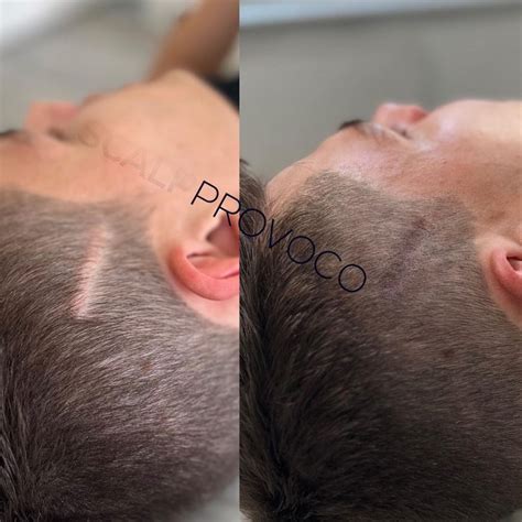 Injury Head Scar Coverage Scalp Provoco