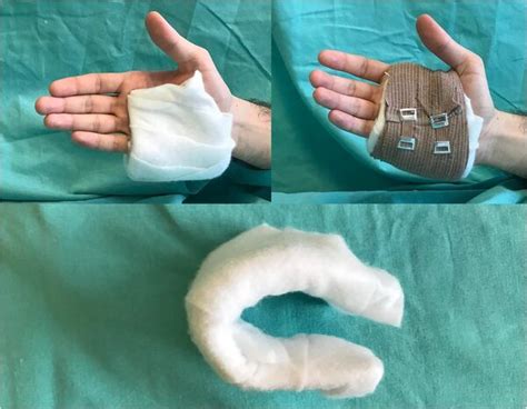 Functional Metacarpal Splint WikiSM Sports Medicine Wiki