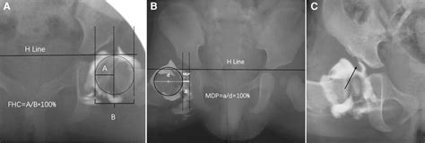 Frontiers Hip Arthrogram Parameters Predict Radiographic Outcomes Of Patients With