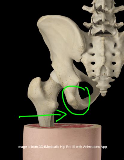 Top Tips That Will Help Your Proximal Hamstring Tendinopathy POGO Physio Gold Coast