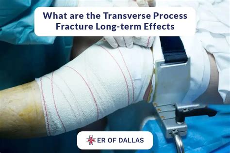 Transverse Fracture Symptoms Causes And Treatment Er Of Dallas
