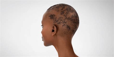 Olumiant® Results In Alopecia Areata Olumiant® Baricitinib