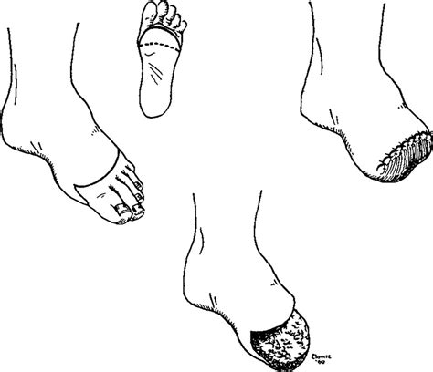 Transmetatarsal Amputations And Arterial Surgery In Diabetic Patients