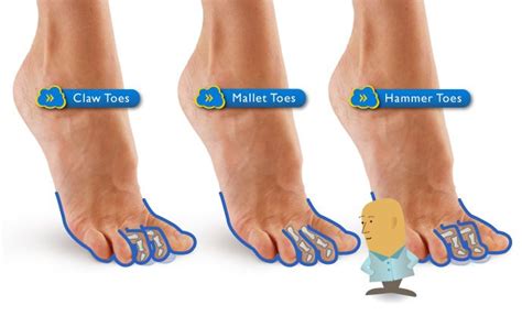 Claw Mallet Hammer Toes Dr Comfort Artofit