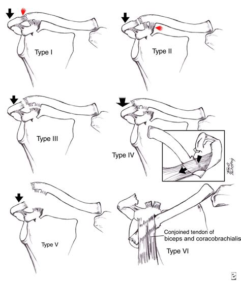 Rockwood Classification Of Acromioclavicular Joint