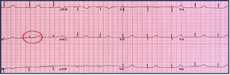 The QT Interval Represents The Time Between The Beginning Of The Q Wave Download Scientific