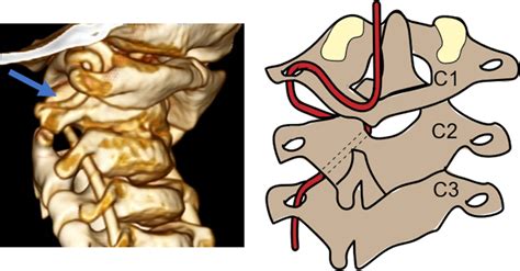 Type A7 C2 Inner Wall Type Va Exits The C3 Transverse Foramen And