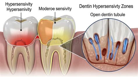 Dental Illustration Showing Hypersensitivity Zones And Open Dentin