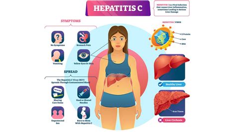 Hepatitis C Basics Liver Infection Symptoms And Prevention Los Angeles Times