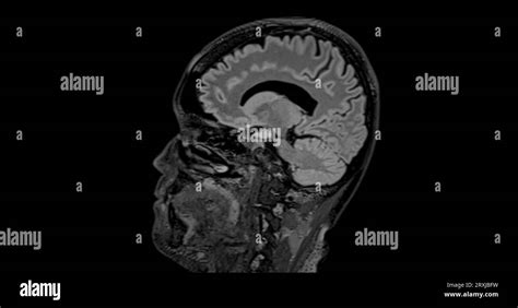 mri brain scan sagittal flair for detect brain diseases sush as stroke disease brain tumors and