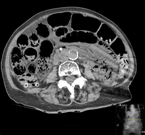 Ct Case 045 • Litfl • Ct Scan Interpretation Ct Case 045 • Litfl • Ct Scan Interpretation